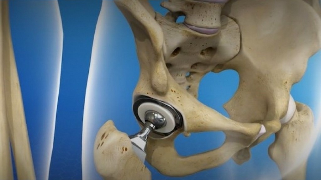 ASTM F3018-17 硬性関節全置換術および人工股関節表面置換術デバイスの評価に関する標準ガイド