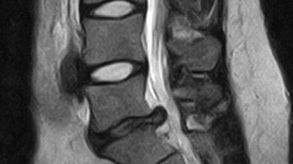 ISO 18192-2 Implantate fir Chirurgie - Verschleiung vun Total ...
